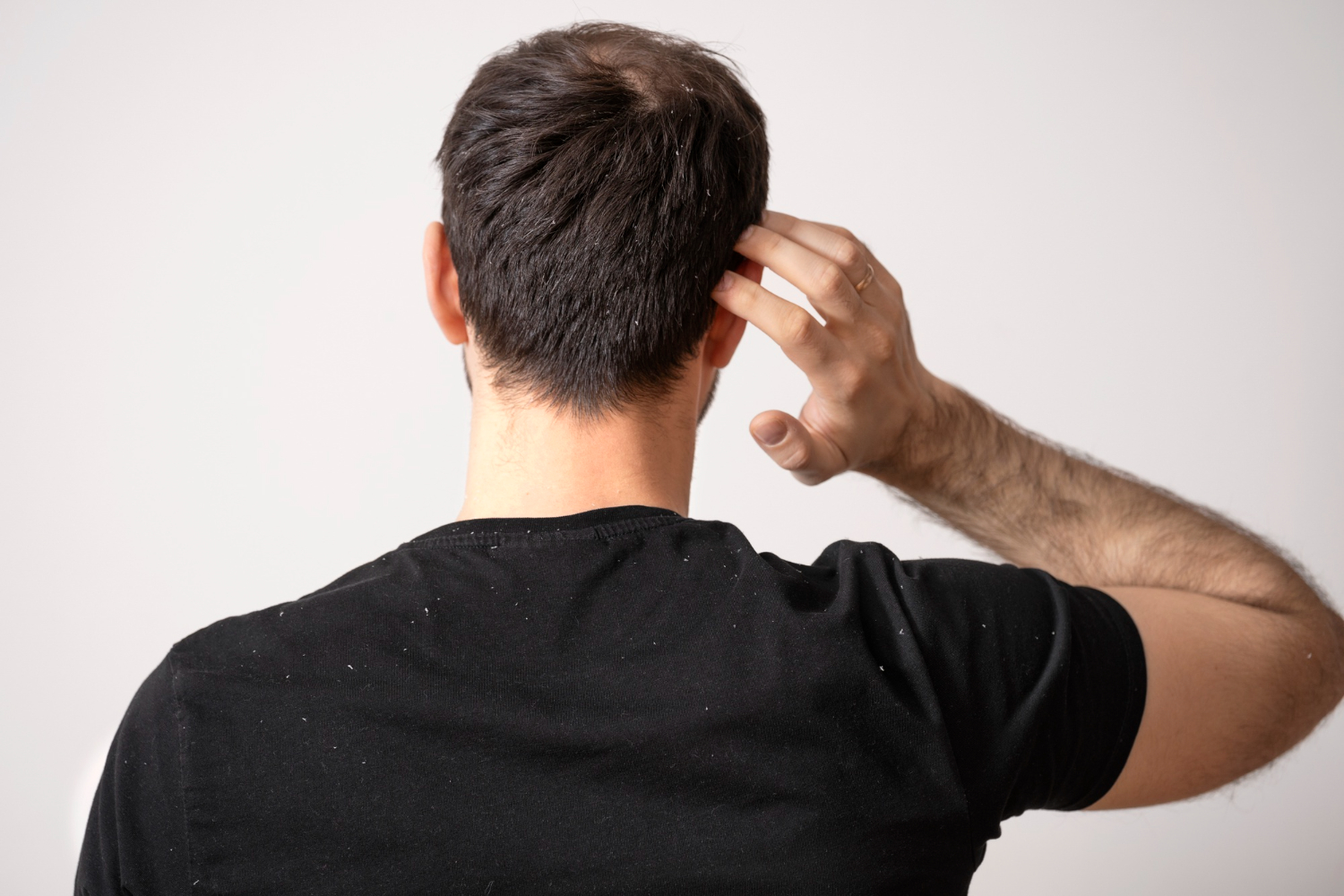 How to Determine the Type of Scalp You Have - HairStuff
